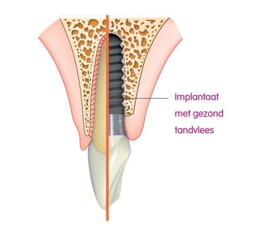 Tandvleesbehandeling – Mondzorgpraktijk Valeriusstraat